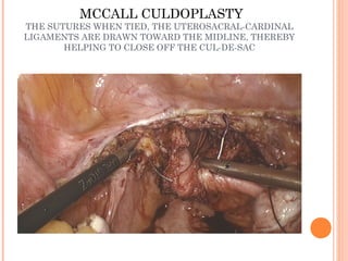 Total Laparoscopic Hysterectomy- Tips, Tricks & Techniques | PPT