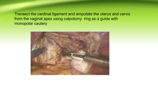 TOTAL LAPROSCOPIC HYSTERECTOMY PROCEDURE | PPT