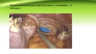 TOTAL LAPROSCOPIC HYSTERECTOMY PROCEDURE | PPT