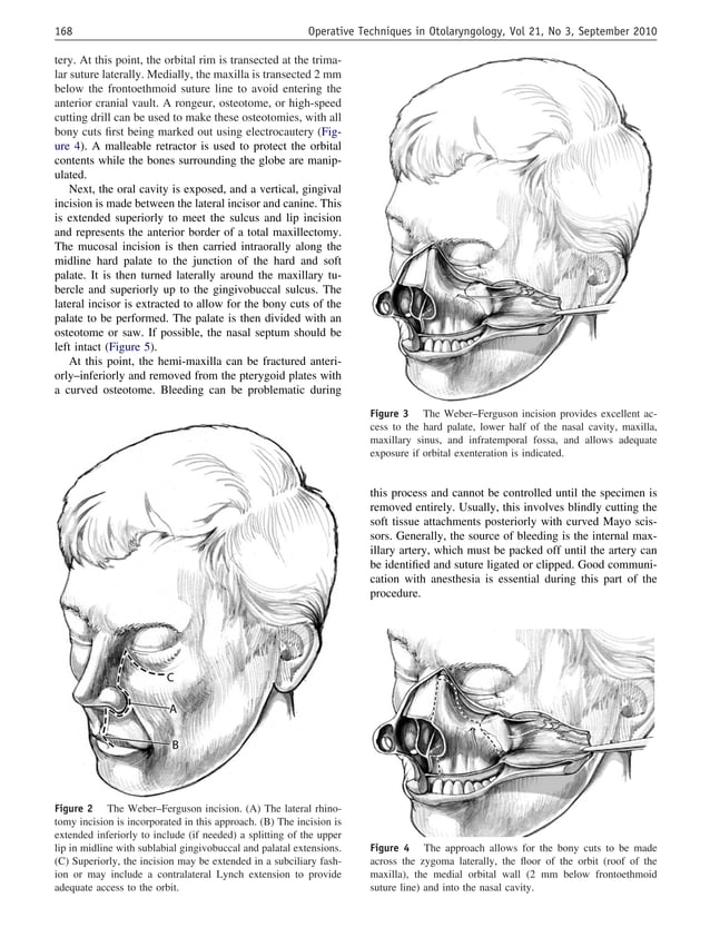 Total maxillectomy | PDF | Ear, Nose and Throat Conditions | Diseases ...
