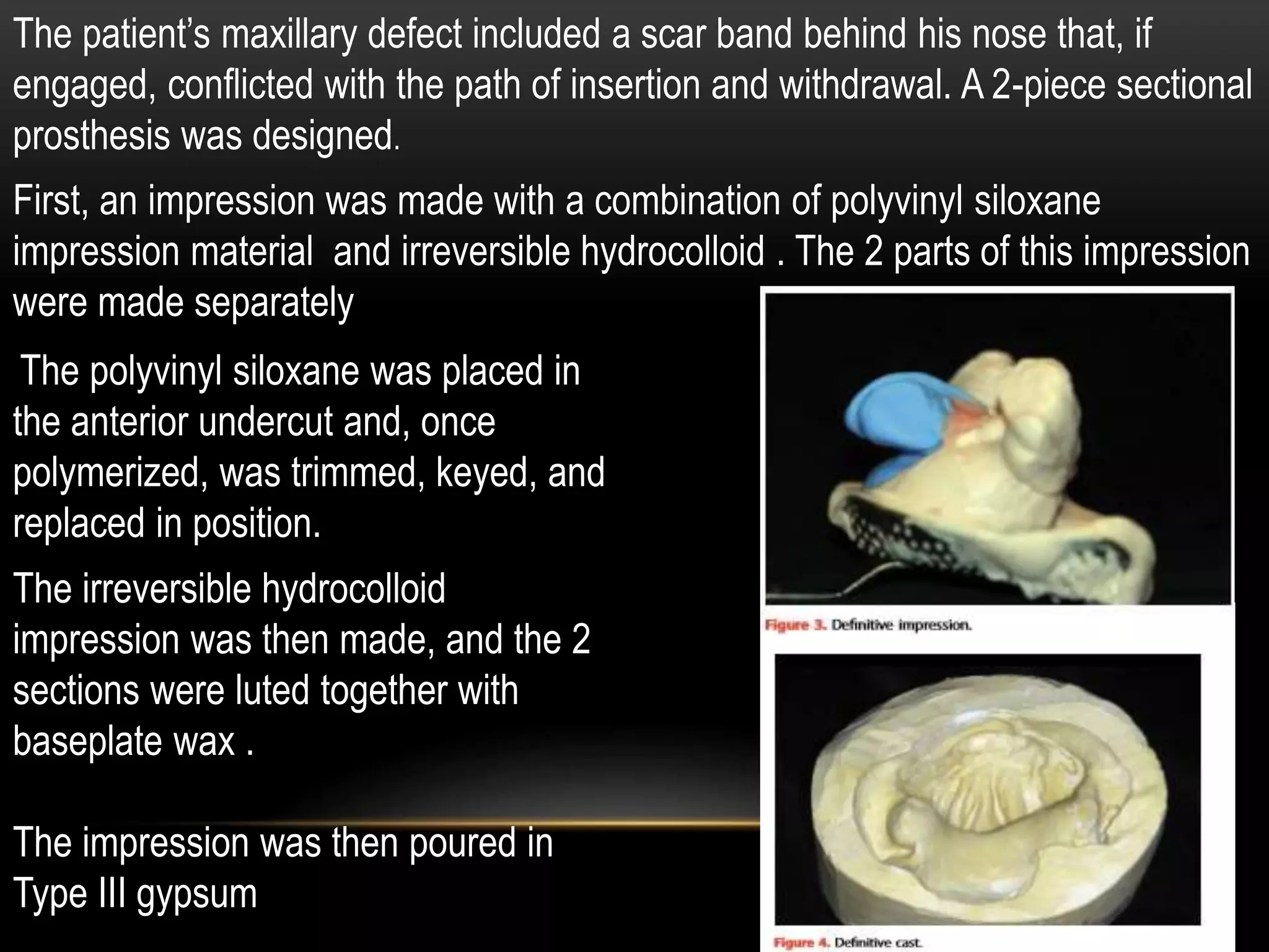 hollow obturator in case of total maxillectomy | PPTX