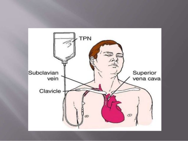What Is Parenteral Nutrition Pn Dr Turner39s Nutrition