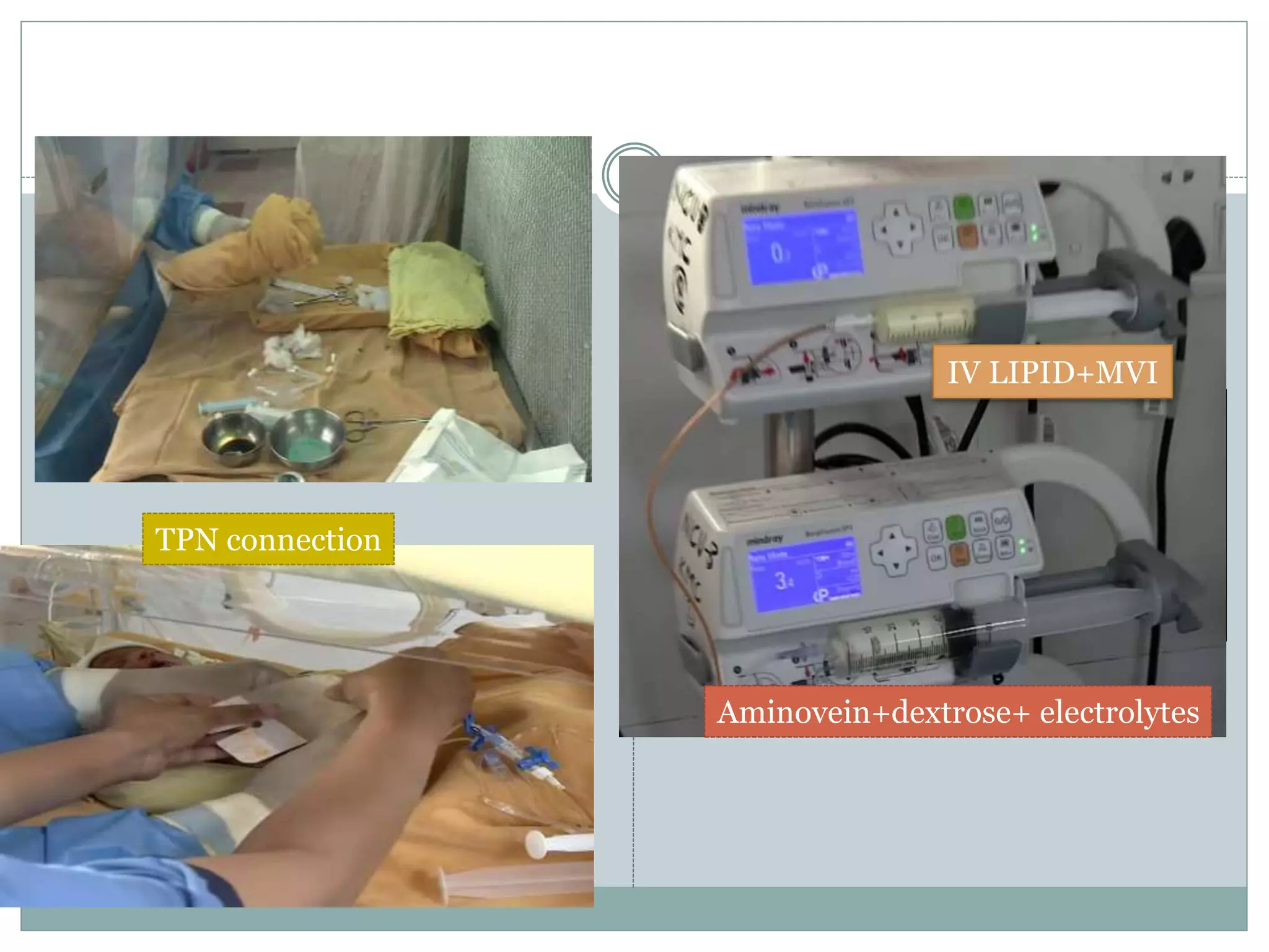 TOTAL PARENTERAL NUTRITION.pptx