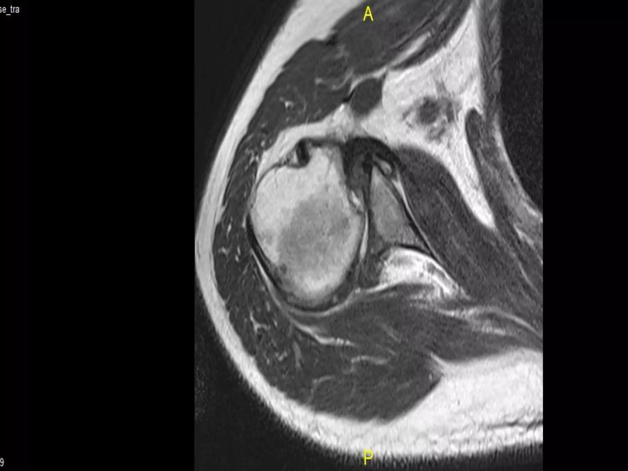 Total shoulder arthroplasty and reverse TSA - Hussain Algawahmed | PPTX