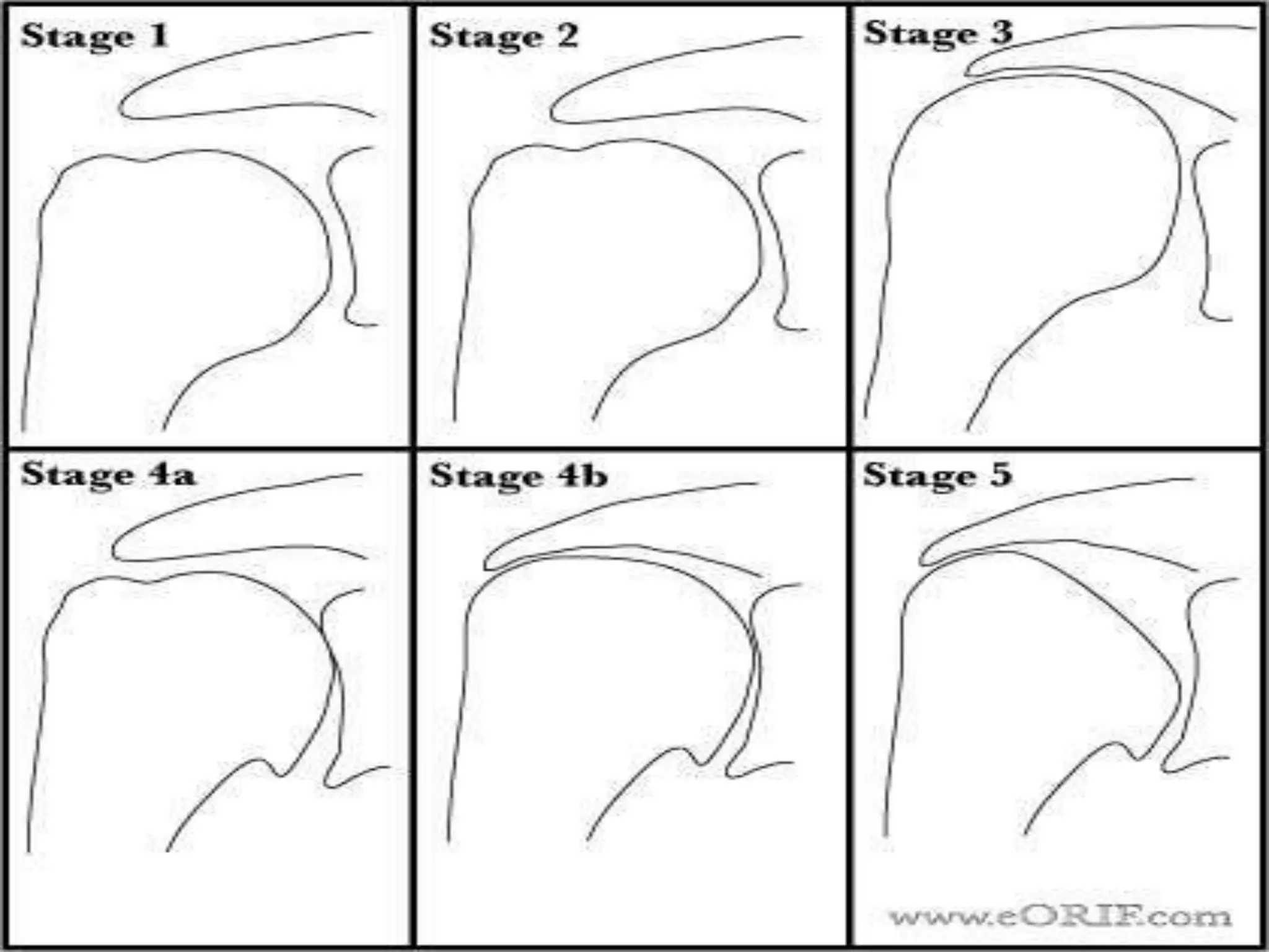 Total shoulder arthroplasty and reverse TSA - Hussain Algawahmed | PPTX