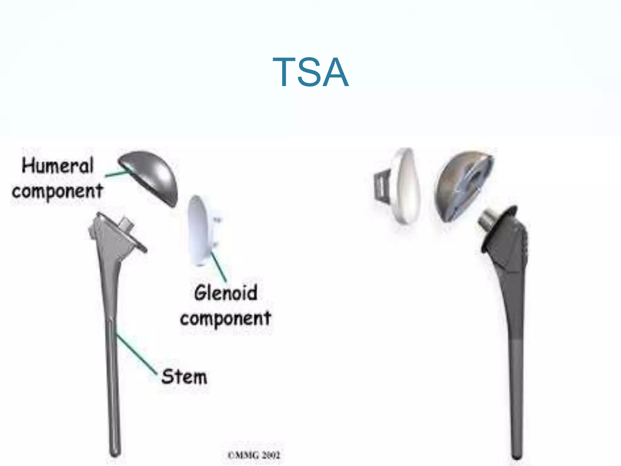 Total shoulder arthroplasty and reverse TSA - Hussain Algawahmed | PPTX