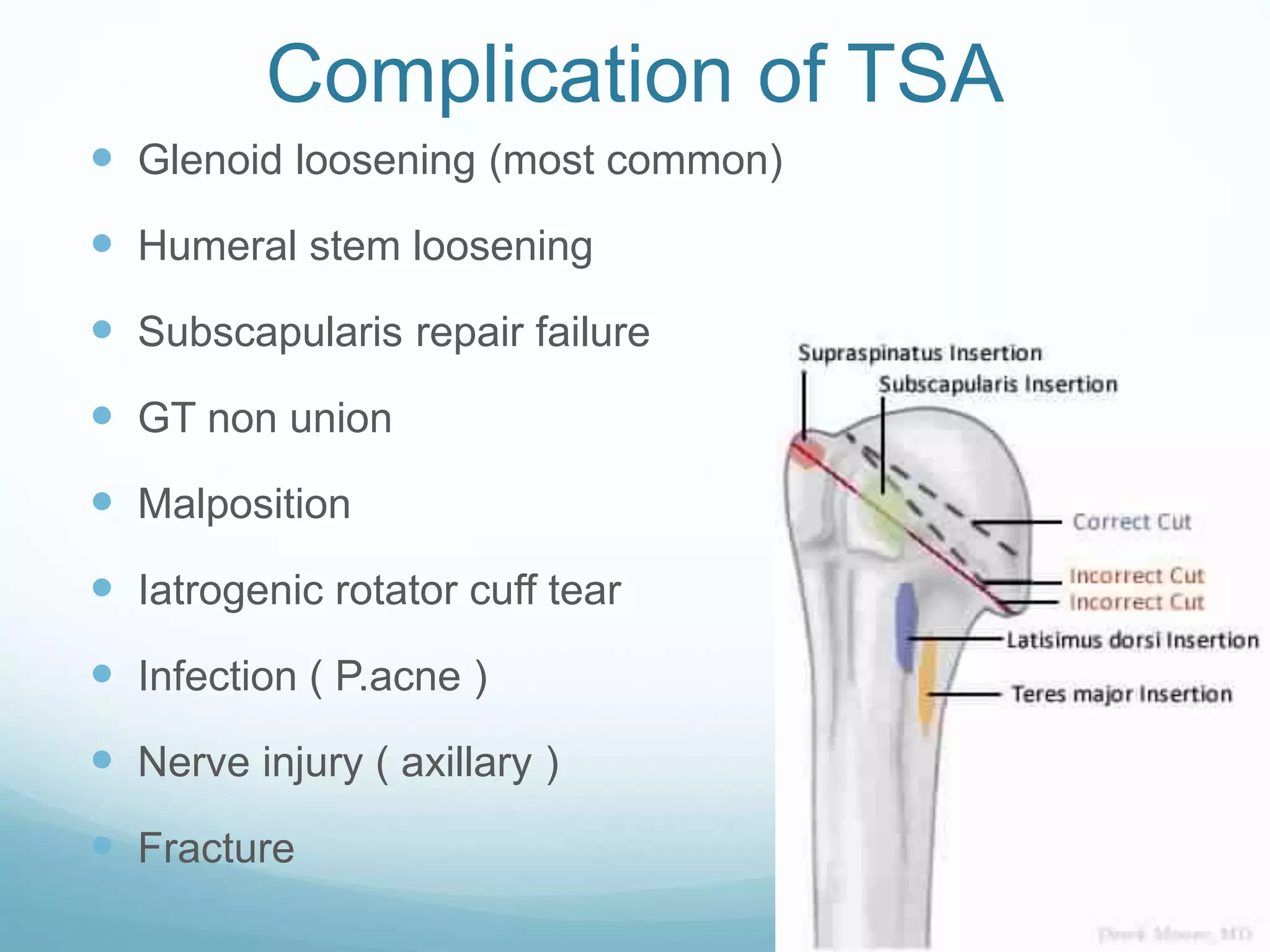 Total shoulder arthroplasty and reverse TSA - Hussain Algawahmed | PPTX