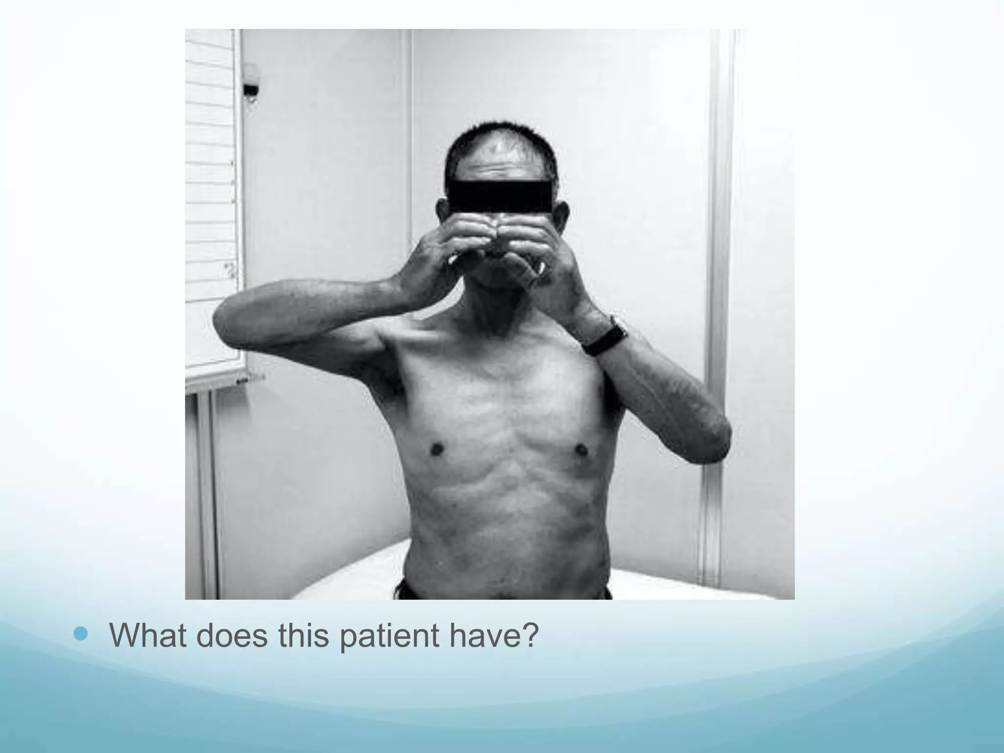 Total shoulder arthroplasty and reverse TSA - Hussain Algawahmed | PPT
