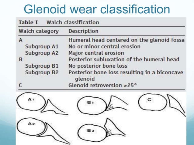 Total shoulder arthroplasty and reverse TSA - Hussain Algawahmed | PPTX