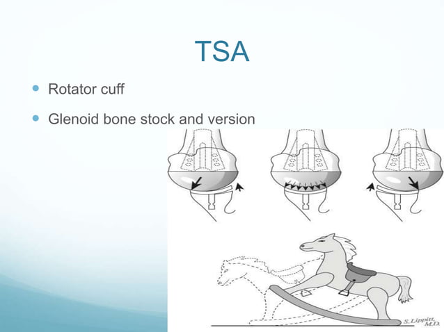 Total shoulder arthroplasty and reverse TSA - Hussain Algawahmed | PPTX