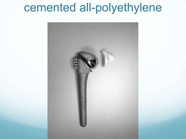 Total shoulder arthroplasty and reverse TSA - Hussain Algawahmed | PPTX