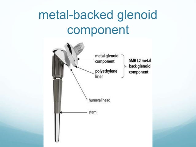Total shoulder arthroplasty and reverse TSA - Hussain Algawahmed | PPTX