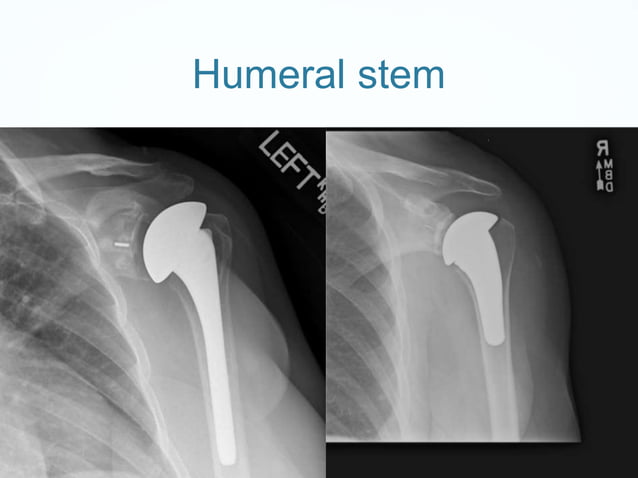 Total shoulder arthroplasty and reverse TSA - Hussain Algawahmed | PPTX