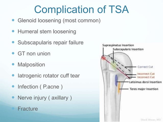 Total shoulder arthroplasty and reverse TSA - Hussain Algawahmed | PPTX