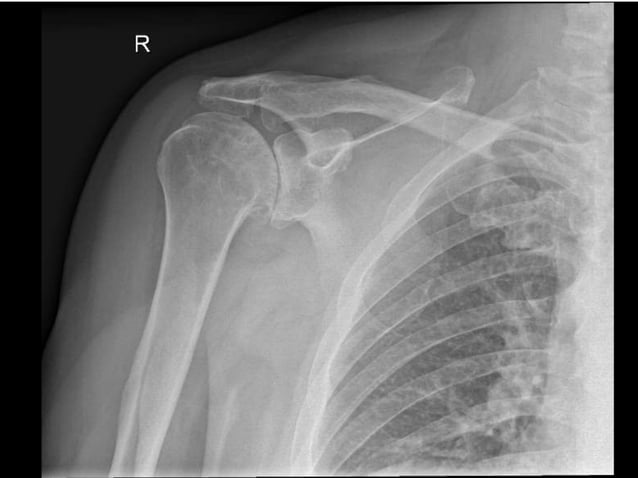 Total shoulder arthroplasty and reverse TSA - Hussain Algawahmed | PPTX