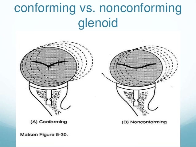 Total shoulder arthroplasty and reverse TSA - Hussain Algawahmed