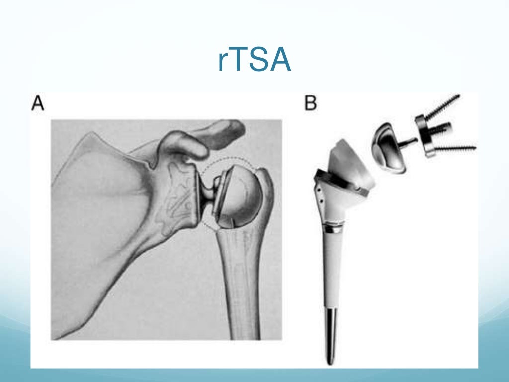 Total shoulder arthroplasty and reverse TSA - Hussain Algawahmed