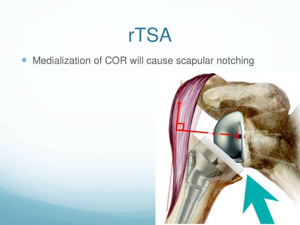 Total shoulder arthroplasty and reverse TSA - Hussain Algawahmed