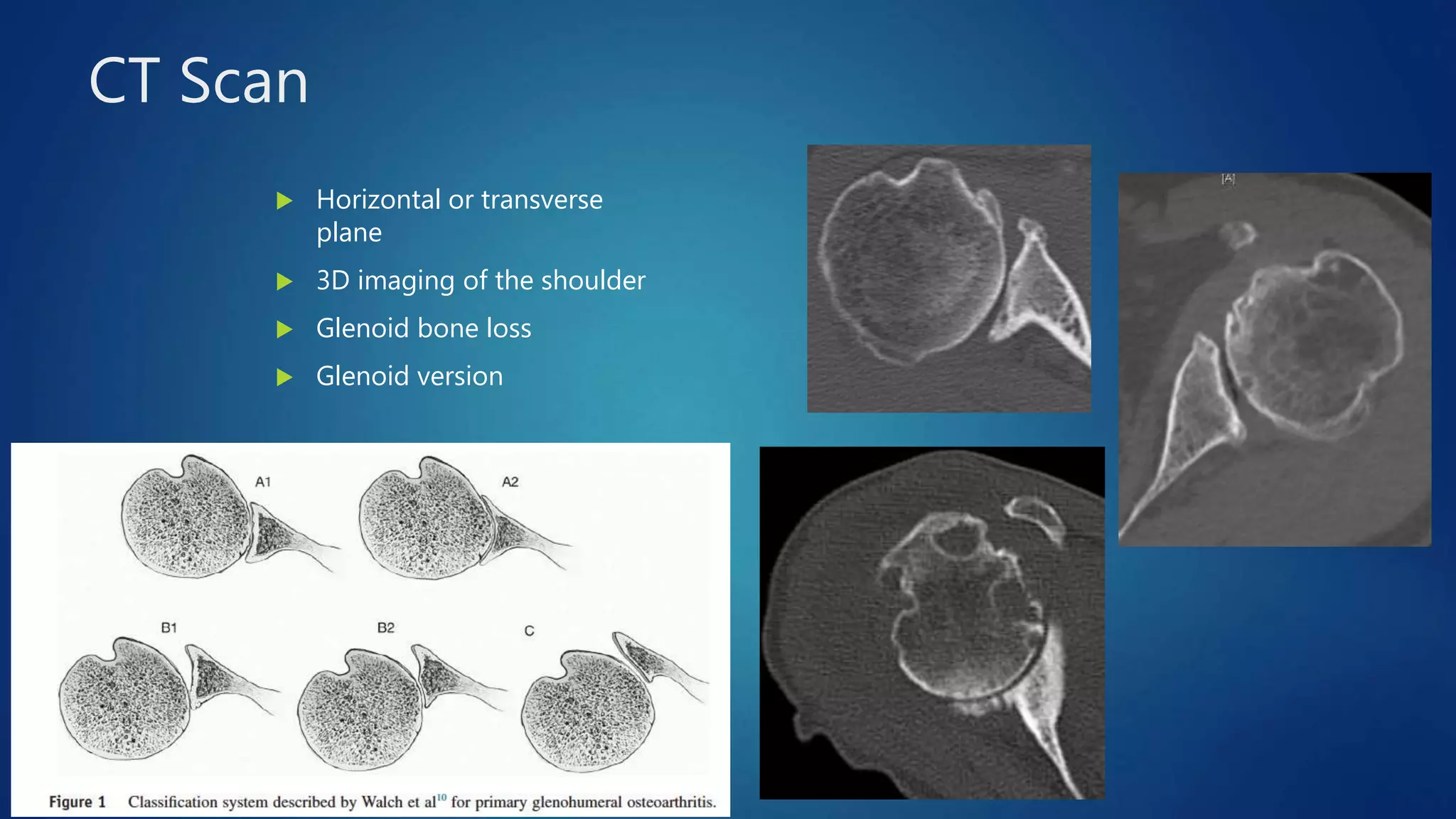 Total Shoulder Arthroplasty | Reverse Shoulder Replacement | South ...