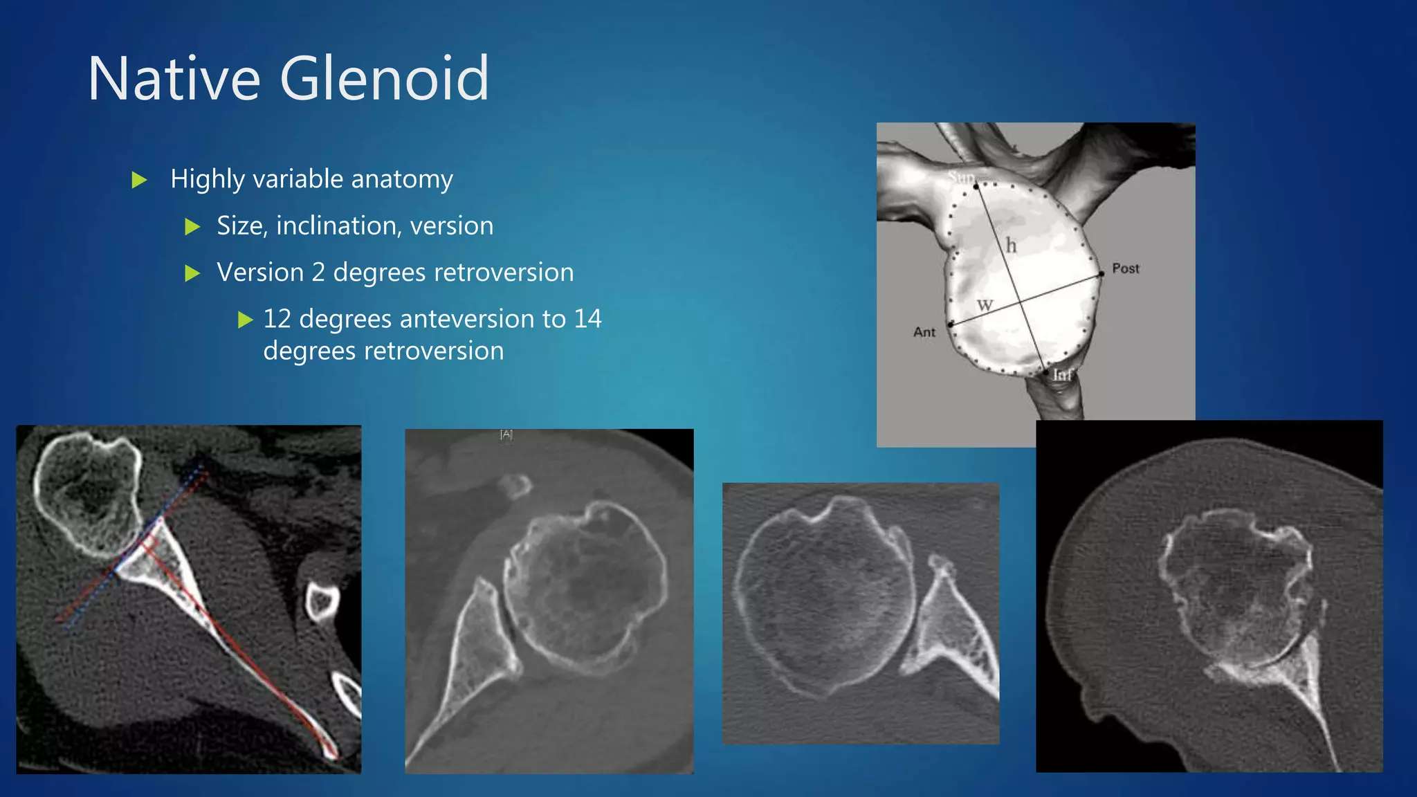 Total Shoulder Arthroplasty | Reverse Shoulder Replacement | South ...