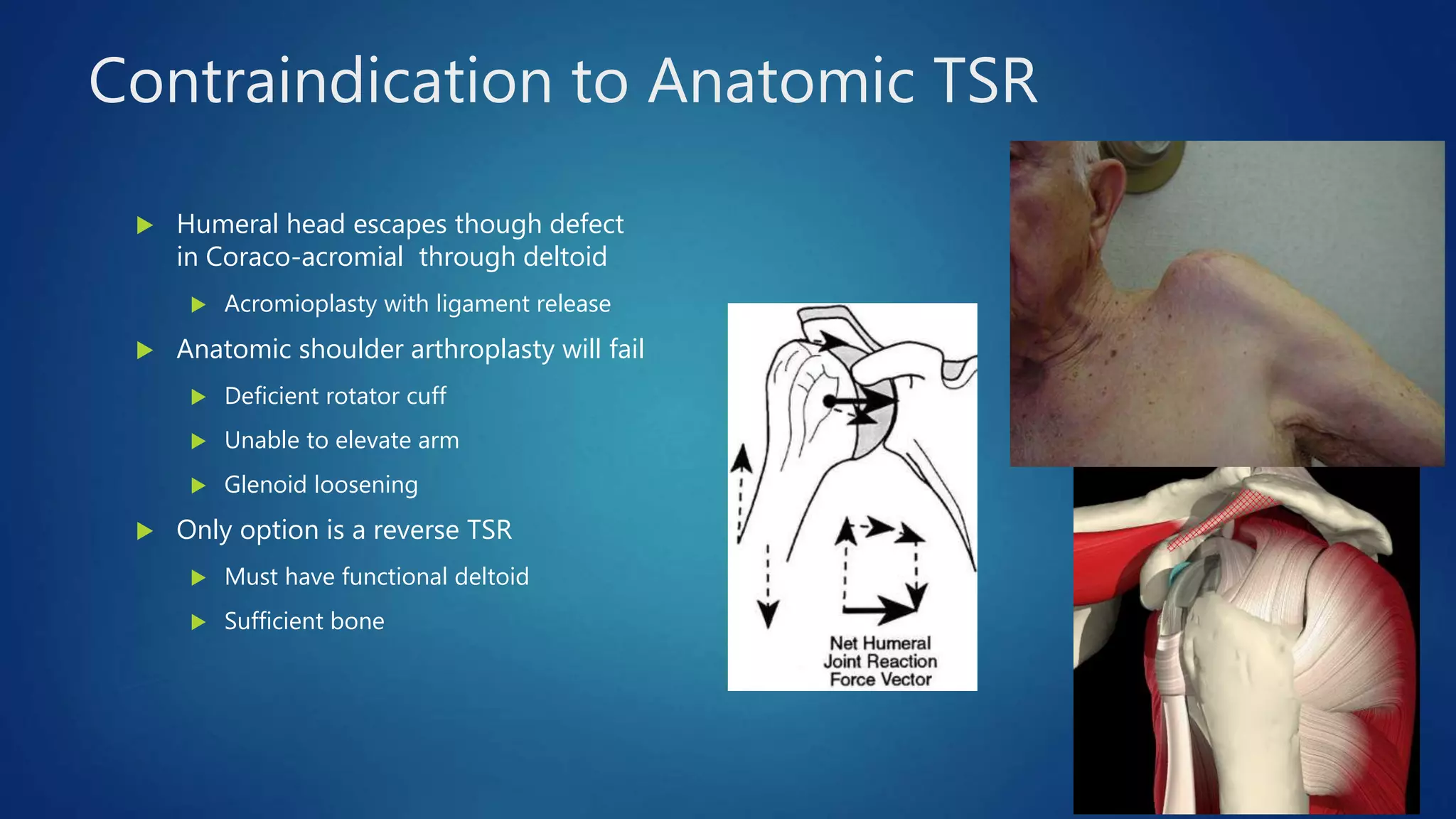 Total Shoulder Arthroplasty | Reverse Shoulder Replacement | South ...