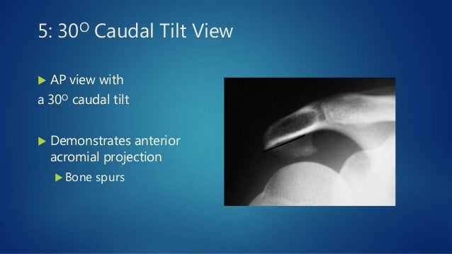 Total Shoulder Arthroplasty | Reverse Shoulder Replacement | South Wi…