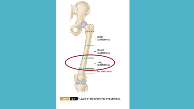 TO Transfemoral Amputation - Wendy YR.pptx