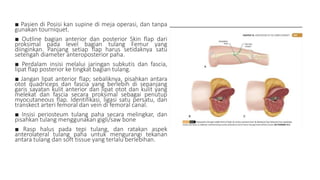 TO Transfemoral Amputation - Wendy YR.pptx
