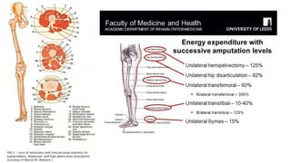 TO Transfemoral Amputation - Wendy YR.pptx