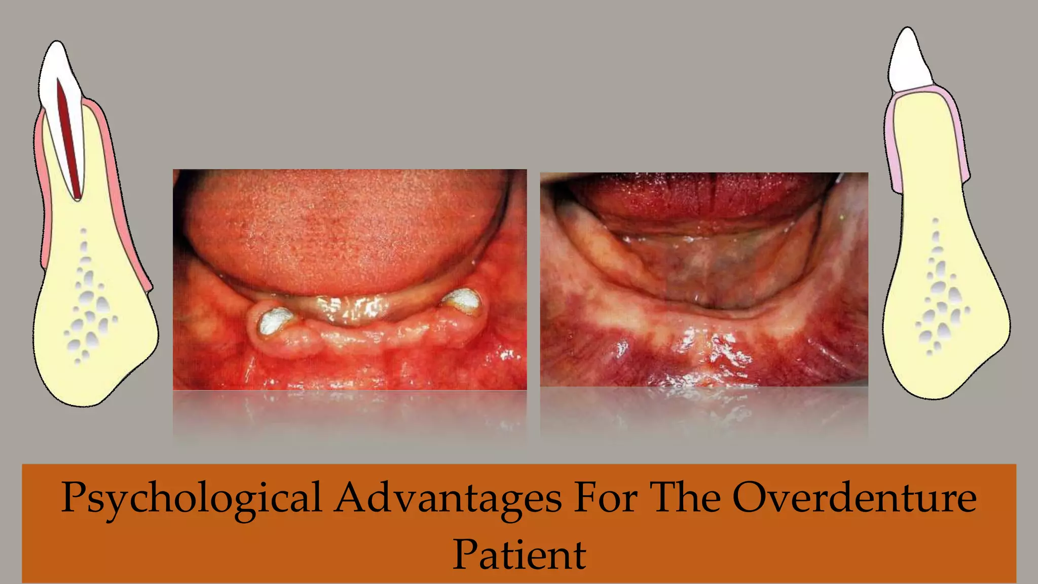 Totth supported overdenture (part 1) | PPTX | Dental Health | Diseases ...