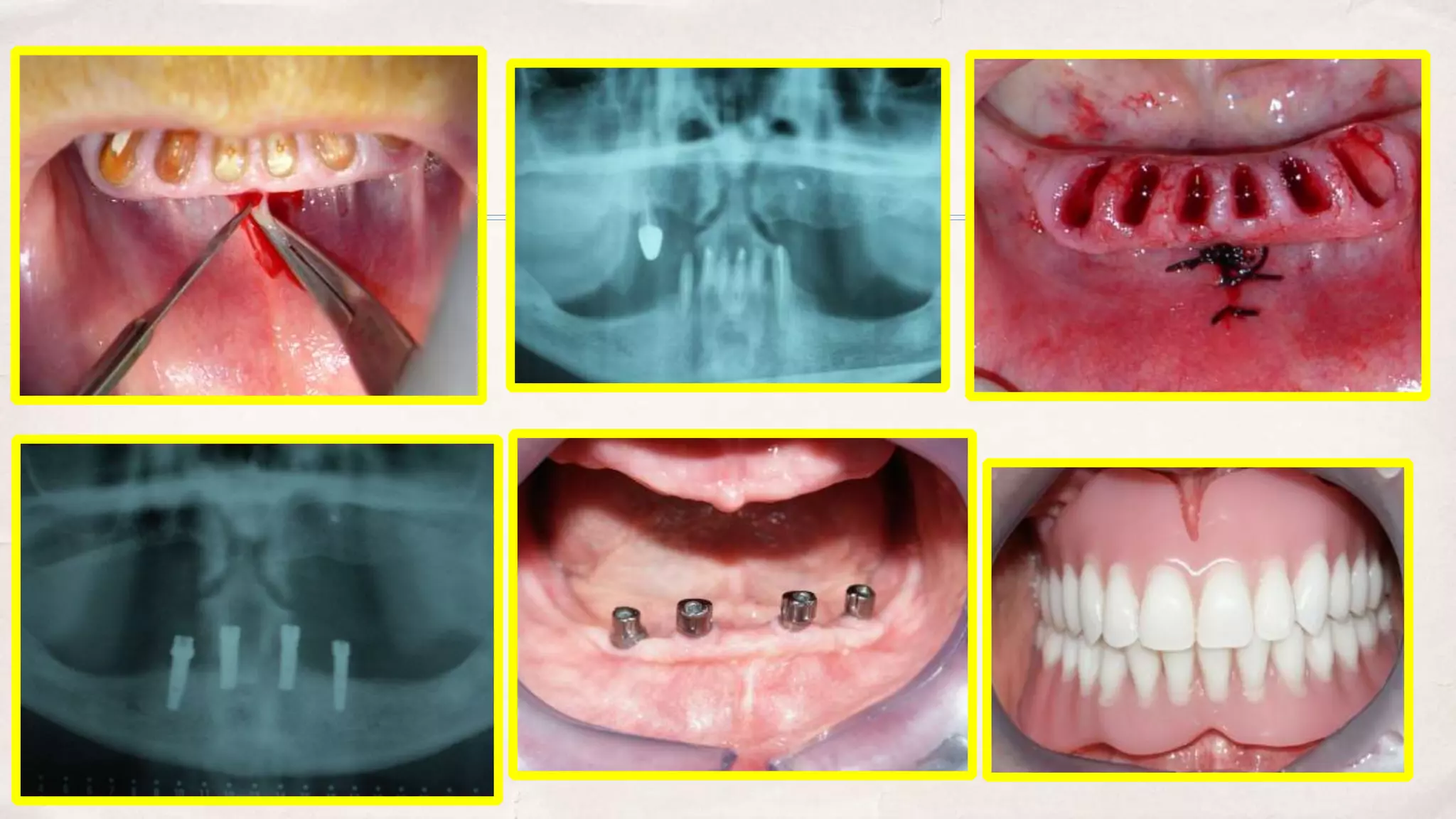 Totth supported overdenture (part 1) | PPTX | Dental Health | Diseases ...