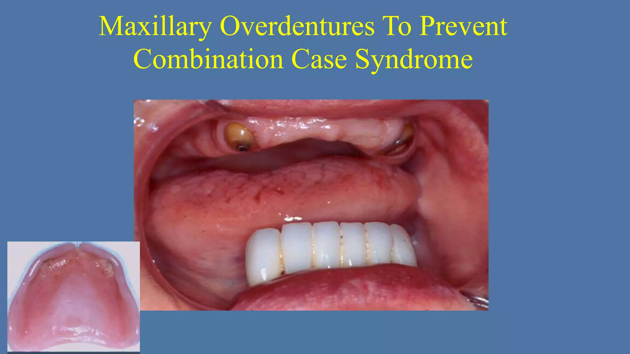 Totth supported overdenture (part 1) | PPTX | Dental Health | Diseases ...