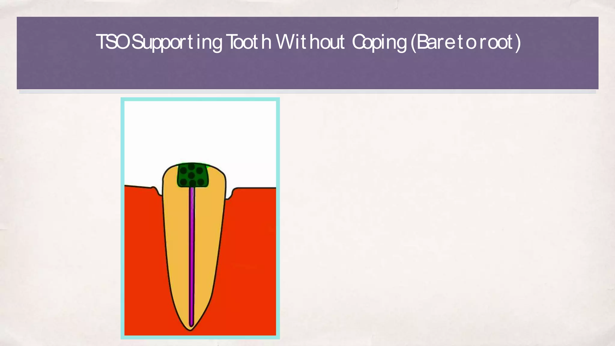 Totth supported overdenture (part 1) | PPTX | Dental Health | Diseases ...