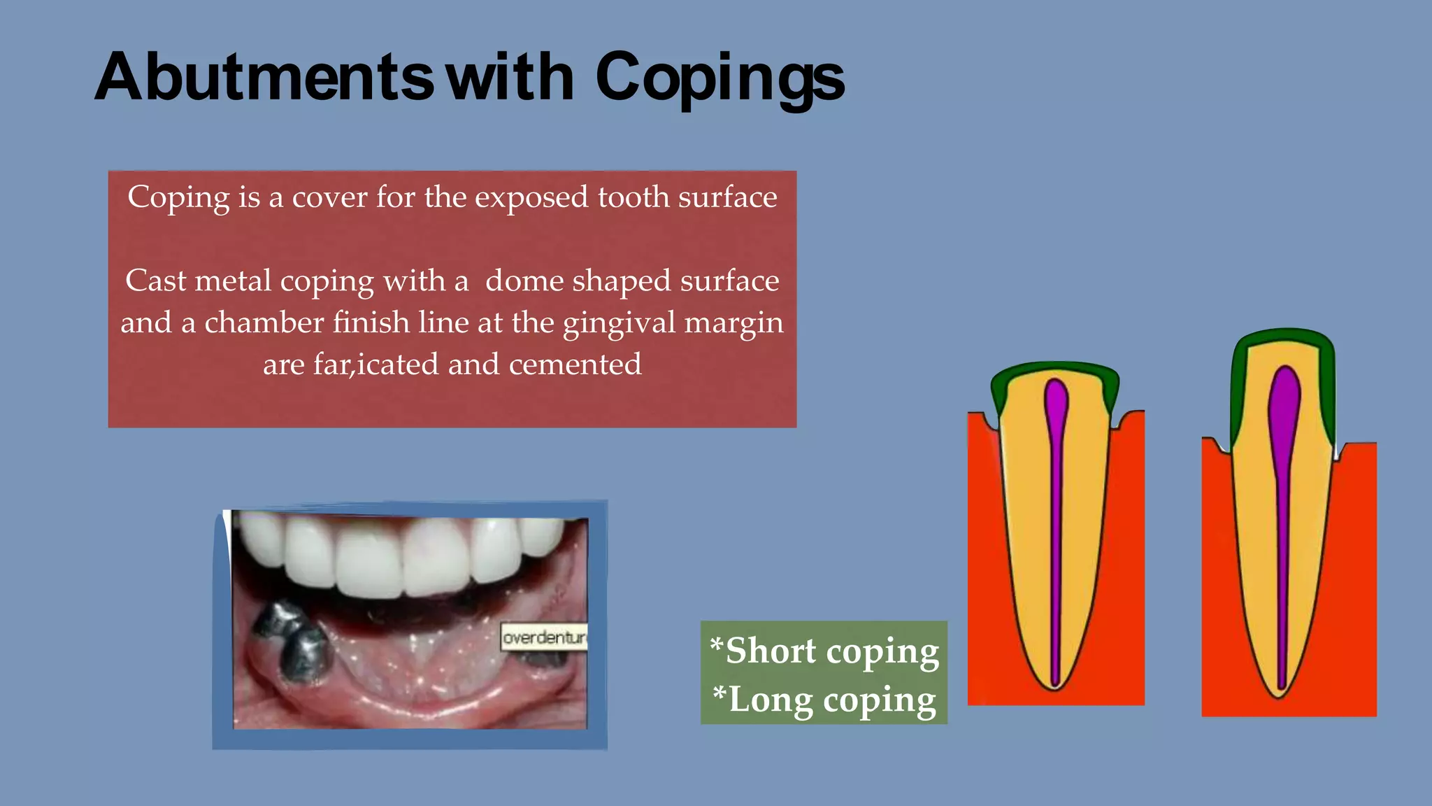 Totth supported overdenture (part 1) | PPTX | Dental Health | Diseases ...