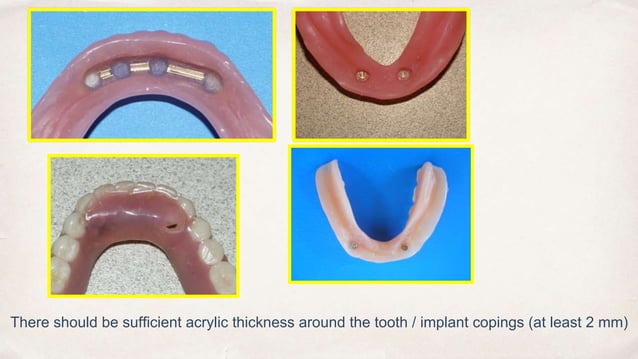 Totth supported overdenture (part 1) | PPTX | Dental Health | Diseases ...