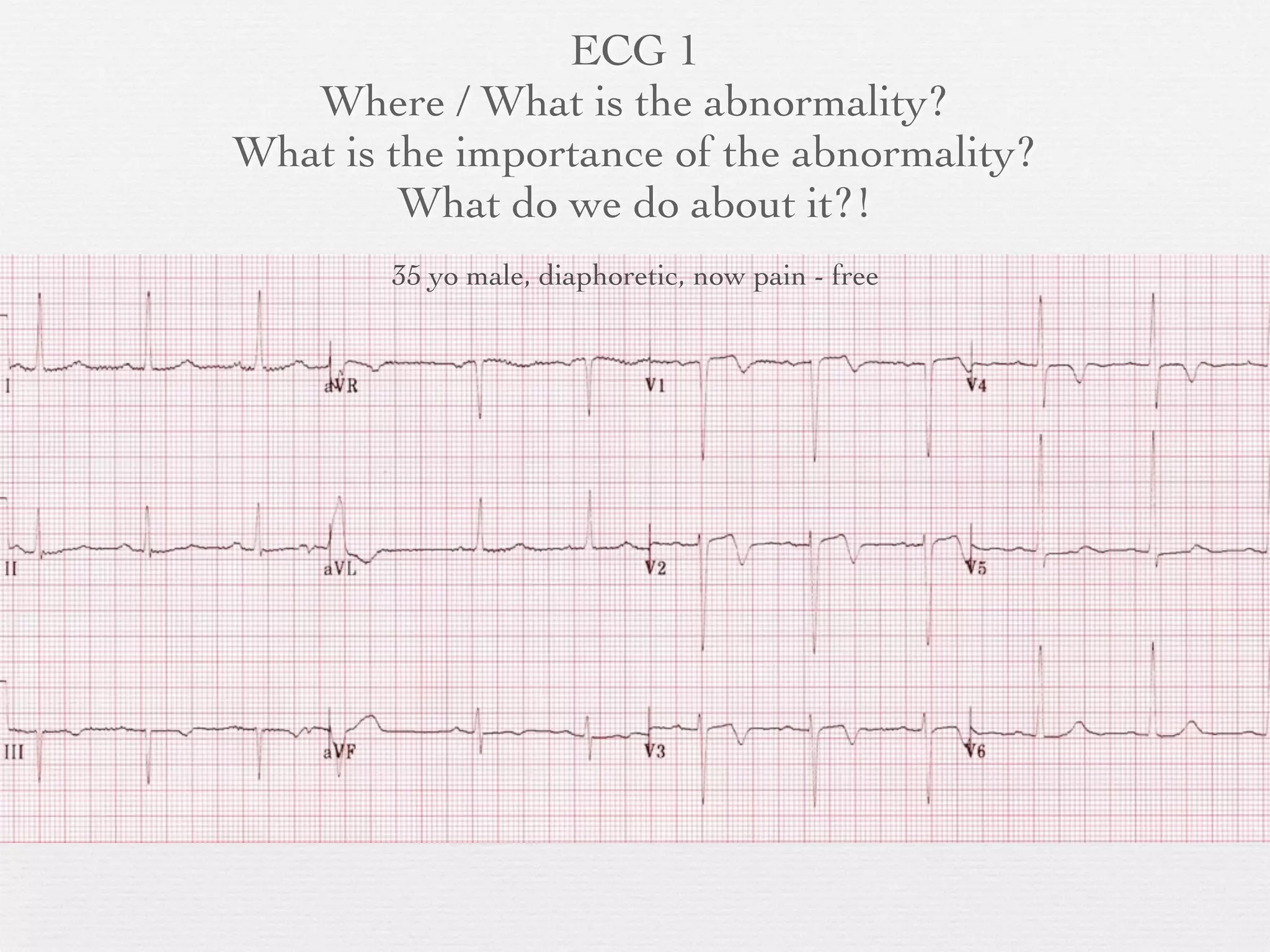 ECG Quiz | PDF