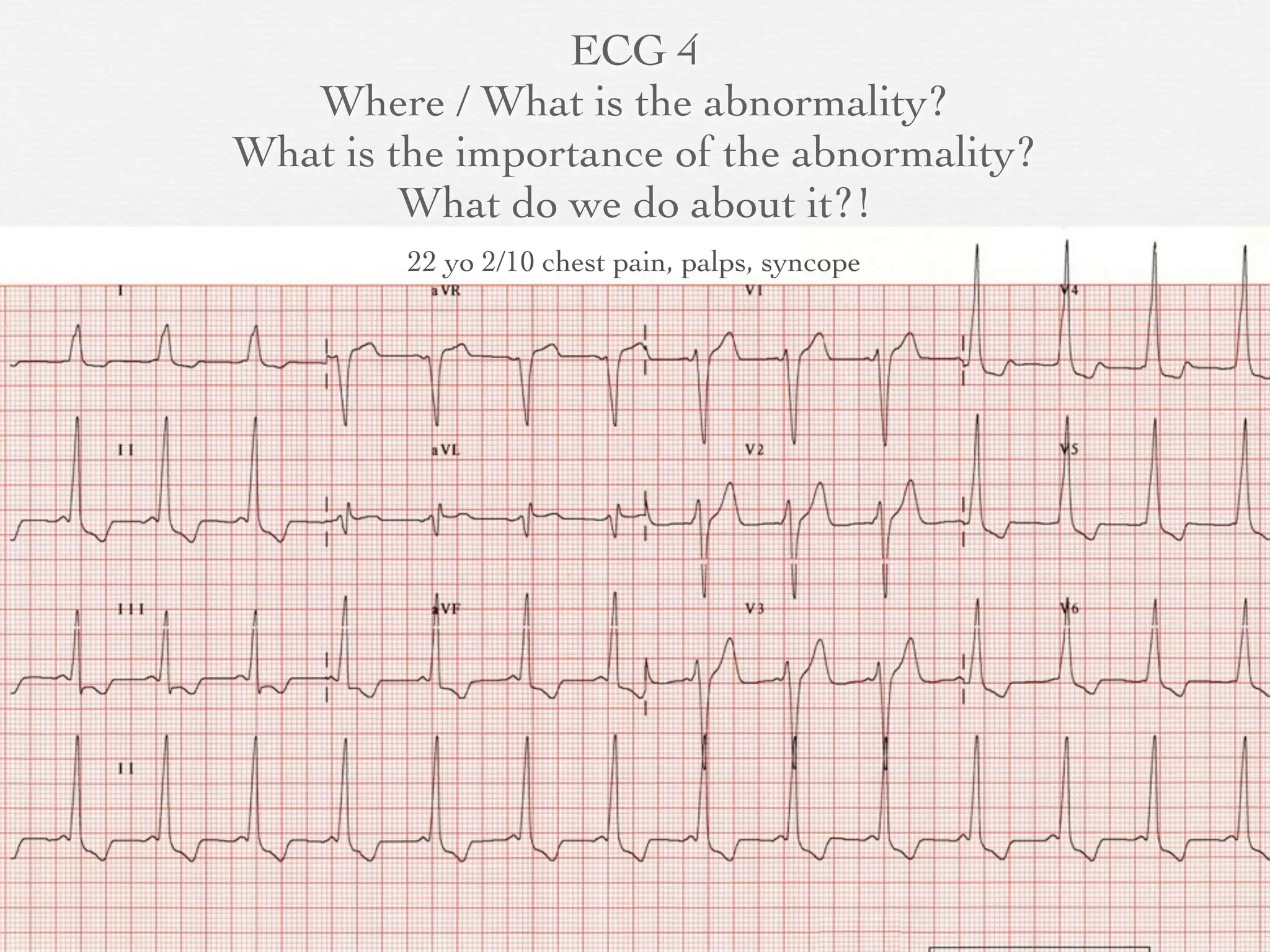 ECG Quiz | PDF | Heart and Cardiovascular Diseases | Diseases and ...
