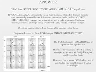 ECG Quiz | PDF