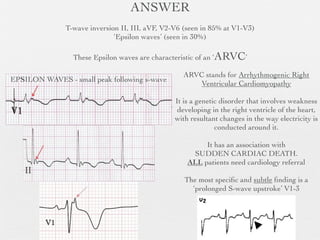 ECG Quiz | PDF
