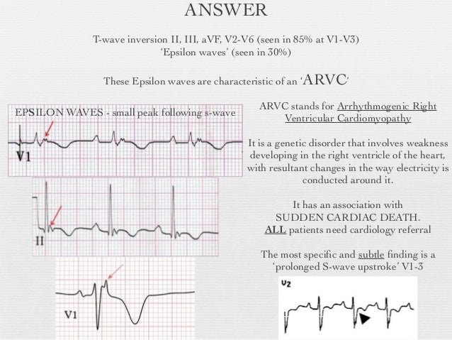 ECG Quiz