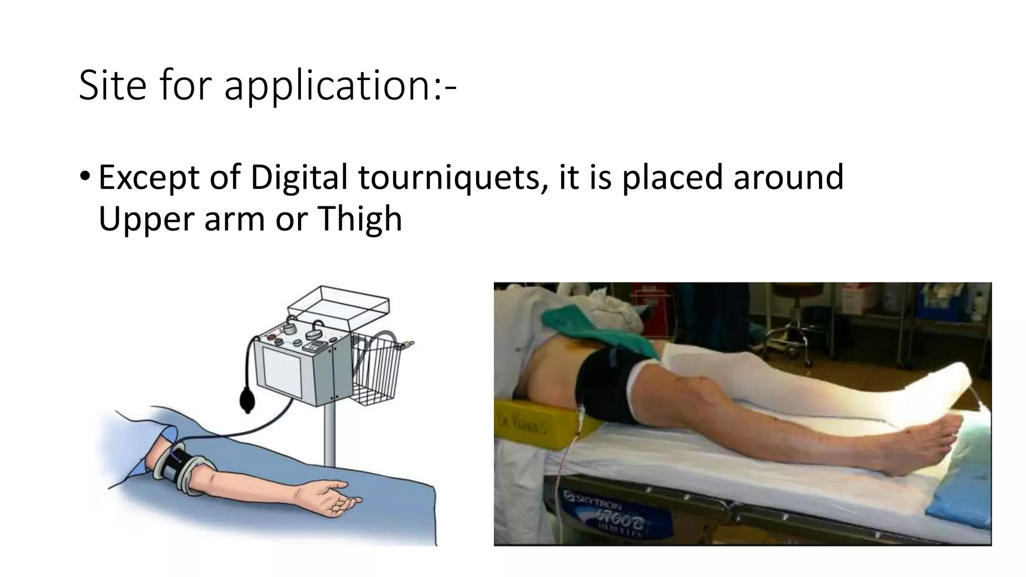 Tourniquets | PPTX