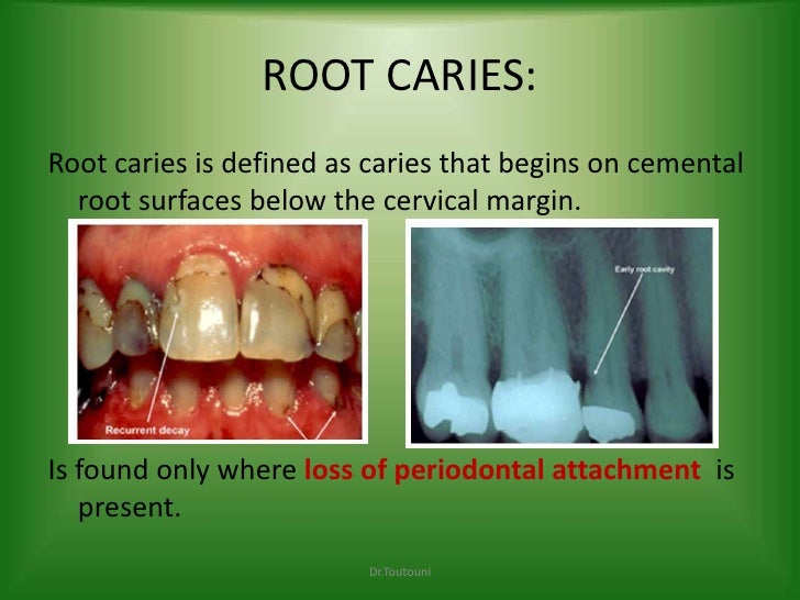 Dental Caries