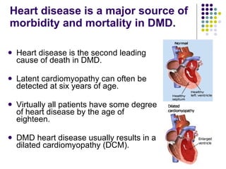 Towards Gene Therapy For Duchenne Muscular Dystrophy Heart Disease | PPT
