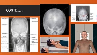 TOWNE VIEW of the skull. X-ray special procedure of skull. | PPTX