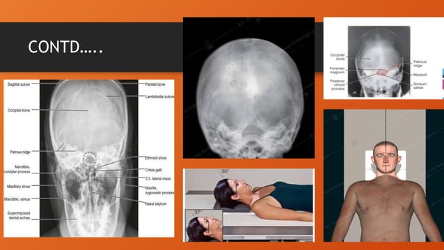 TOWNE VIEW of the skull. X-ray special procedure of skull. | PPTX