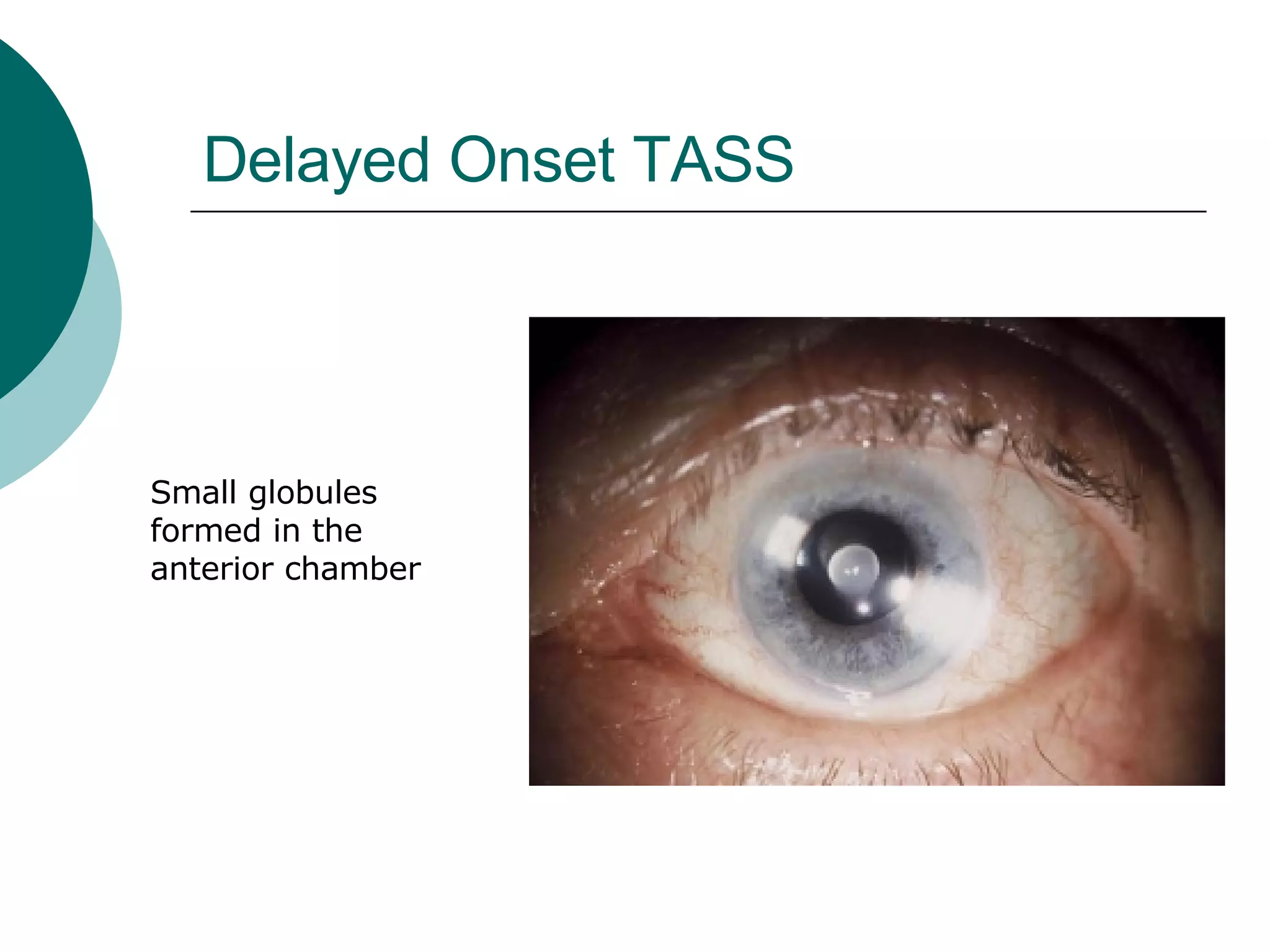 Toxic Anterior Segment Syndrome | PPT