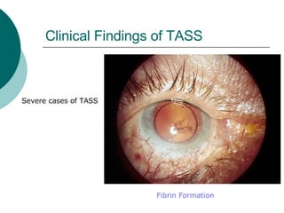 Toxic Anterior Segment Syndrome | PPT