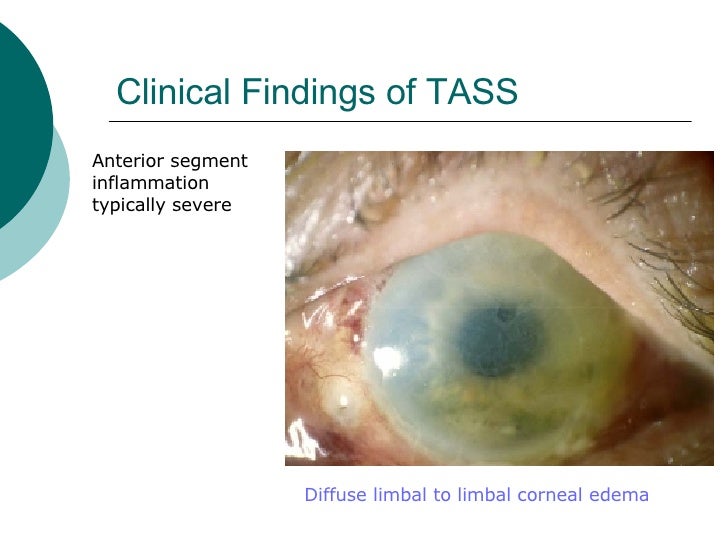 Toxic Anterior Segment Syndrome