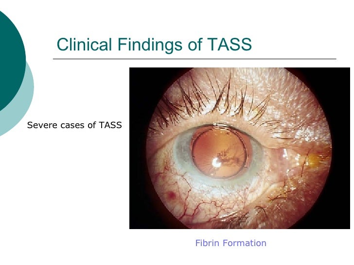 Toxic Anterior Segment Syndrome
