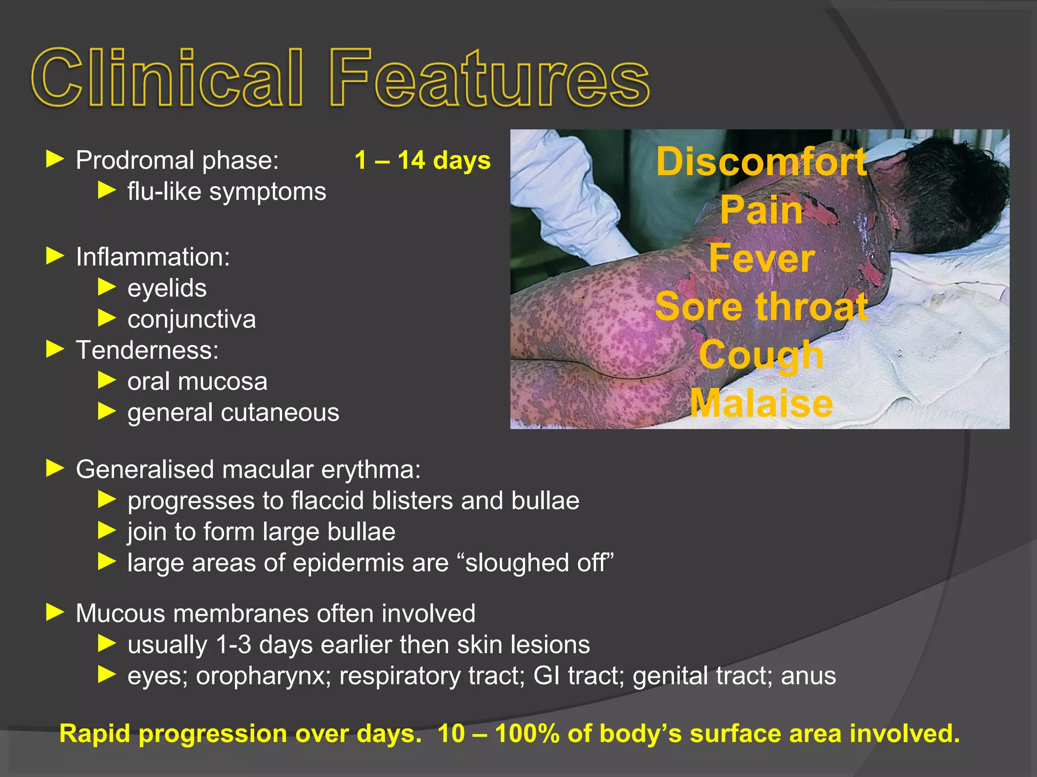 Toxic Epidermal Necrolysis | PPT